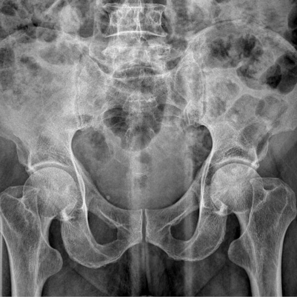 Hip Replacement Lawsuit Claims System Failure Caused Woman To Suffer ...