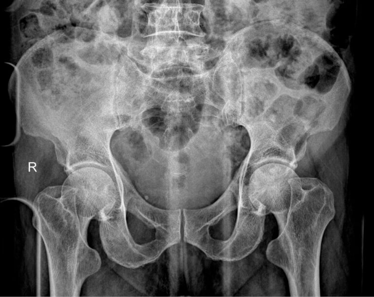 Biomet Hip Lawsuit Filed Over Defective M2A Metal-on-Metal Implant ...