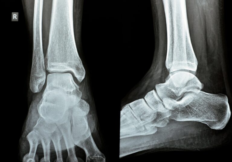 Hintermann H3 Ankle Replacement Failures Occur in 31.8% of Patients at ...