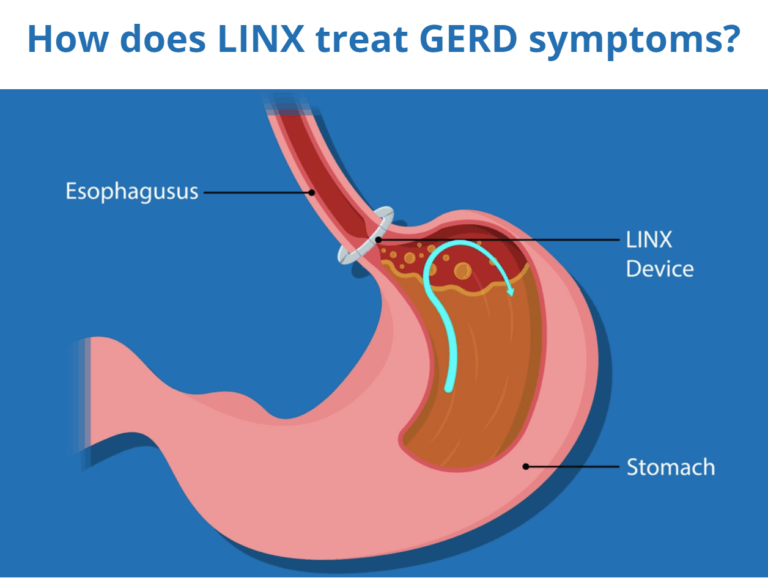 LINX Device Lawsuits and Settlement Updates: December 2025