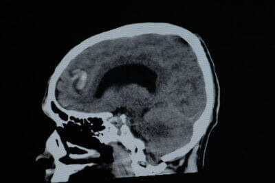 Eli Lilly Claims Kisunla Brain Swelling Side Effects Can Be Reduced ...