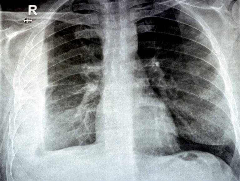 Silicosis From Quartz Countertops Poses Devastating Risks for Workers ...