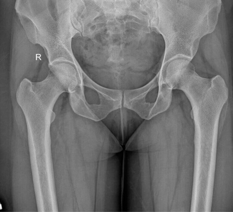 Zimmer Biomet CPT Hip System Linked to Increased Risk of Thigh Bone ...