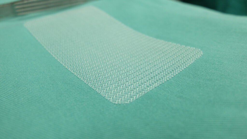 Ventral Hernia Mesh Linked to Lower Recurrence Rates than Non-Mesh ...