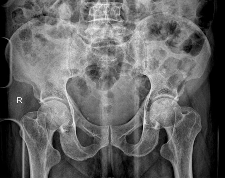 Biomet Hip Lawsuit Filed Over Defective M2A Metal-on-Metal Implant ...