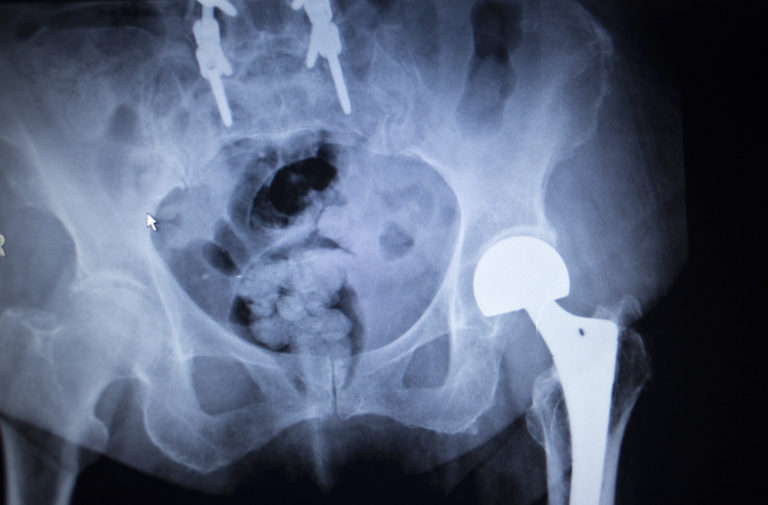 Exactech Hip Replacement Lawsuit Filed Over "Poly Wear" and "Metallosis ...