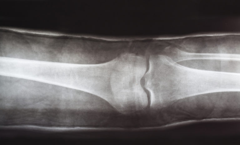 Exactech Knee Recall Issued for Optetrak, Optetrak Logic and Truliant ...